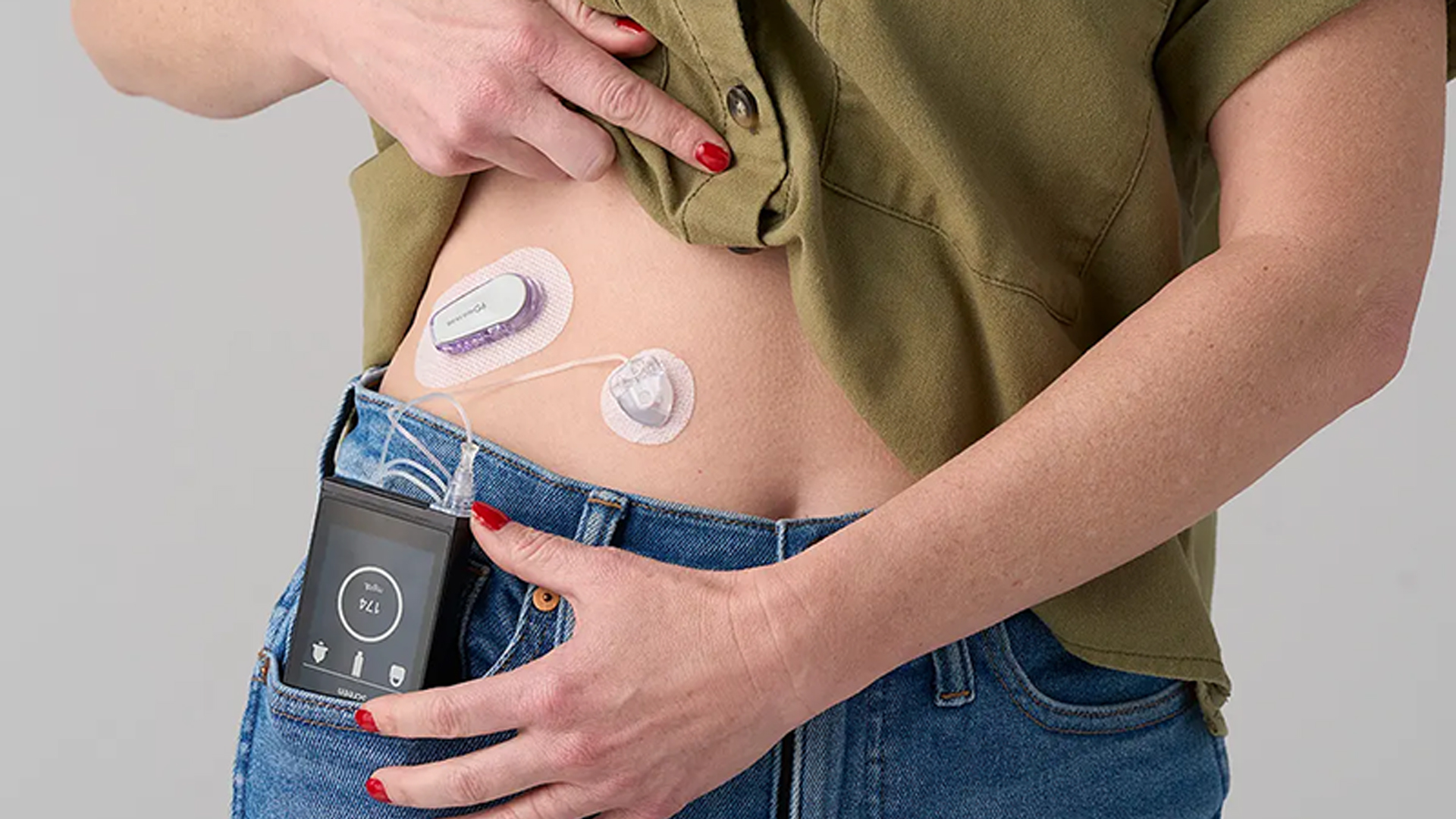 iLet von Beta Bionics: neues AID-System mit Alleinstellungsmerkmalen ...